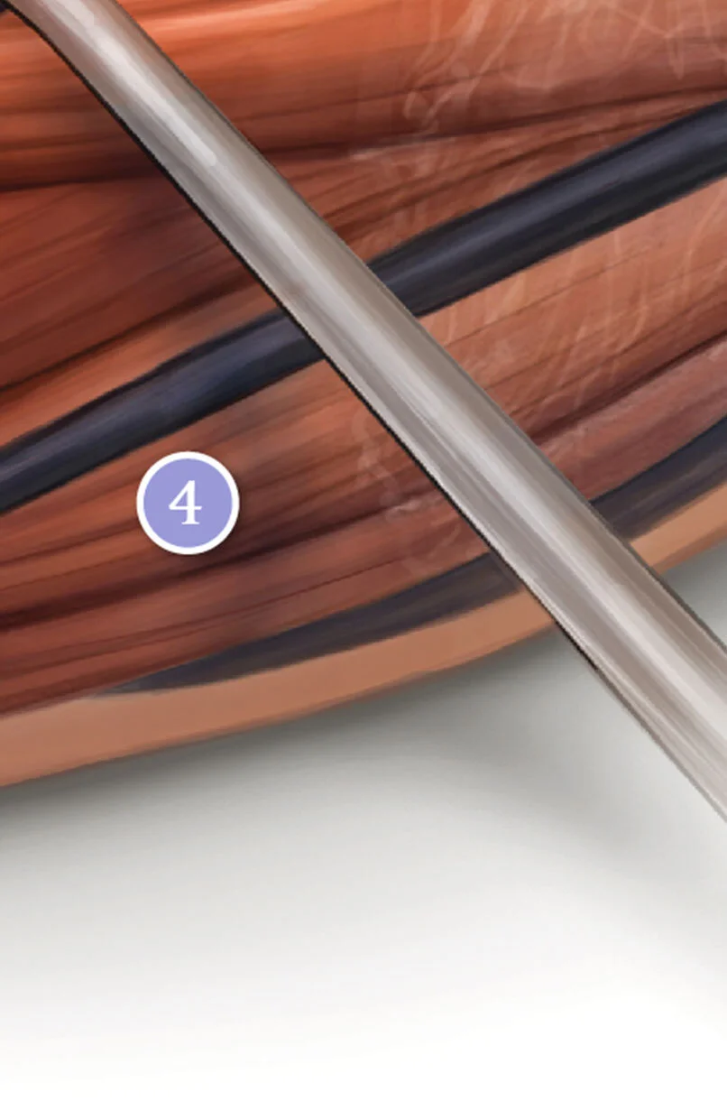 Henry Approach to the Radius - medical illustration — Biotic Artlab