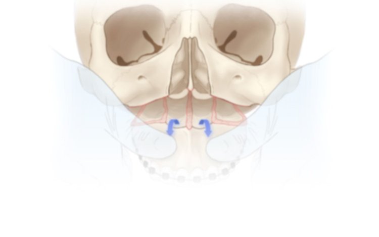 Maxillary Osteotomy | Medical Illustrations — Biotic Artlab