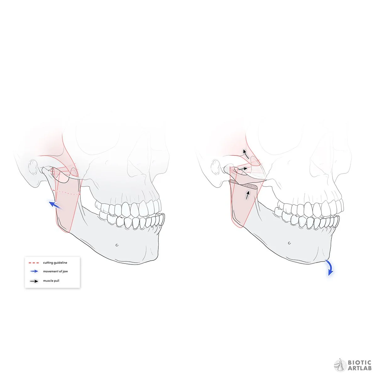 Maxillary Osteotomy | Medical Illustrations — Biotic Artlab