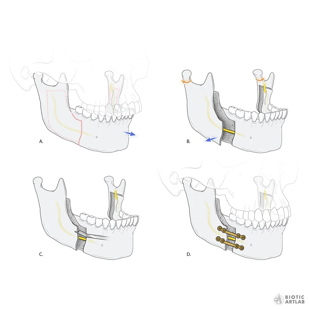 Maxillary Osteotomy | Medical Illustrations — Biotic Artlab