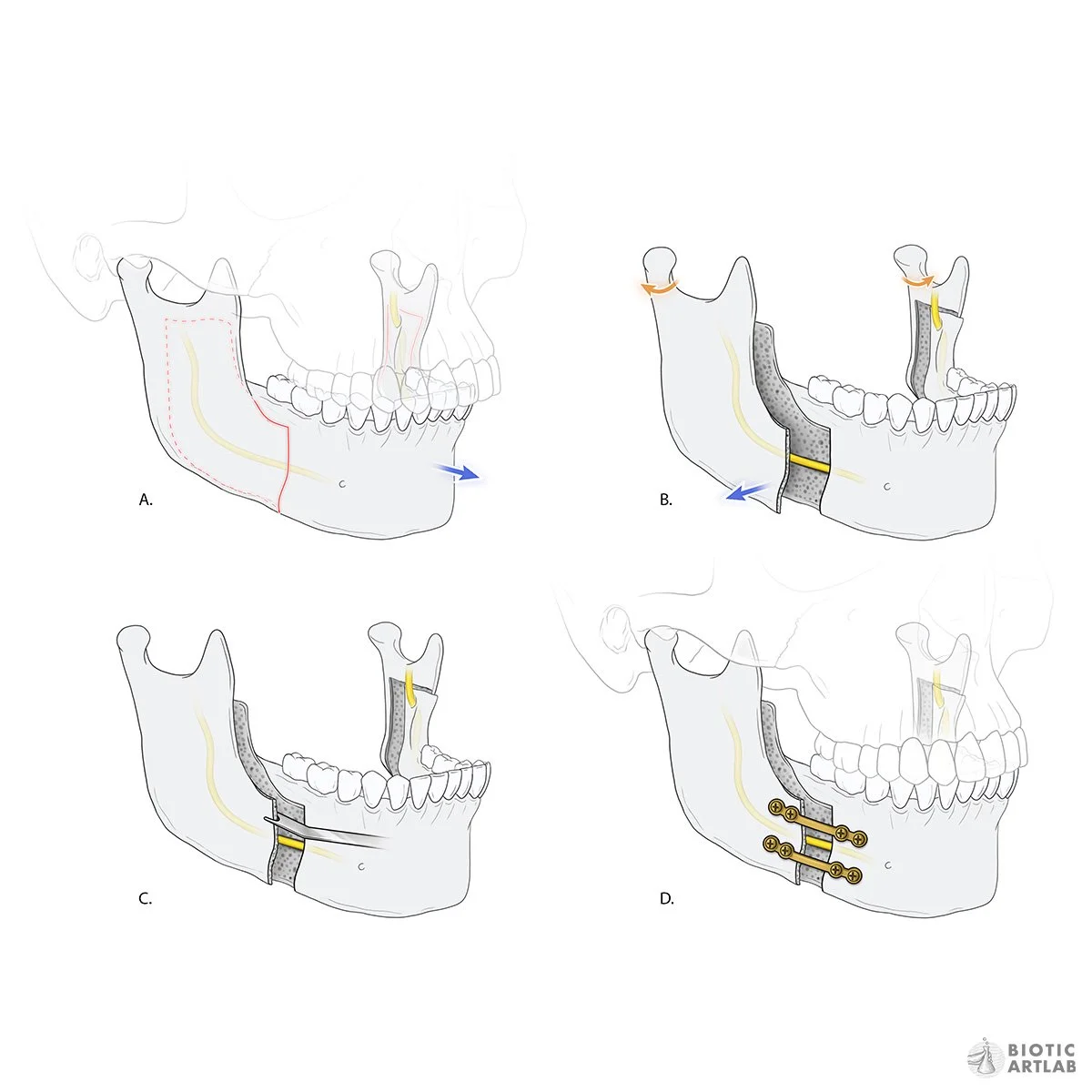 Maxillary Osteotomy | Medical Illustrations — Biotic Artlab