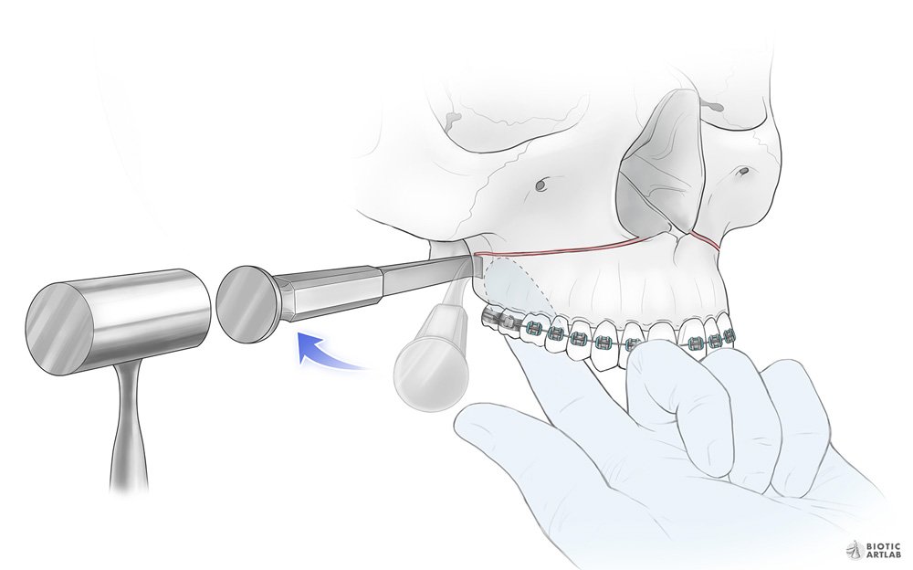 Maxillary Osteotomy | Medical Illustrations — Biotic Artlab