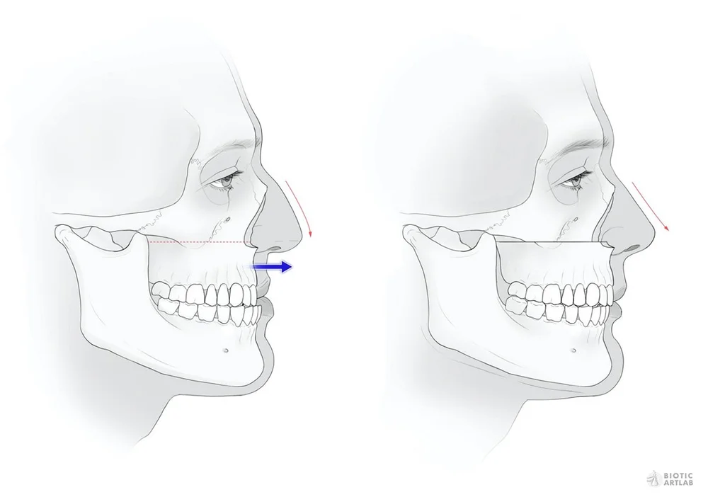 Maxillary Osteotomy | Medical Illustrations — Biotic Artlab