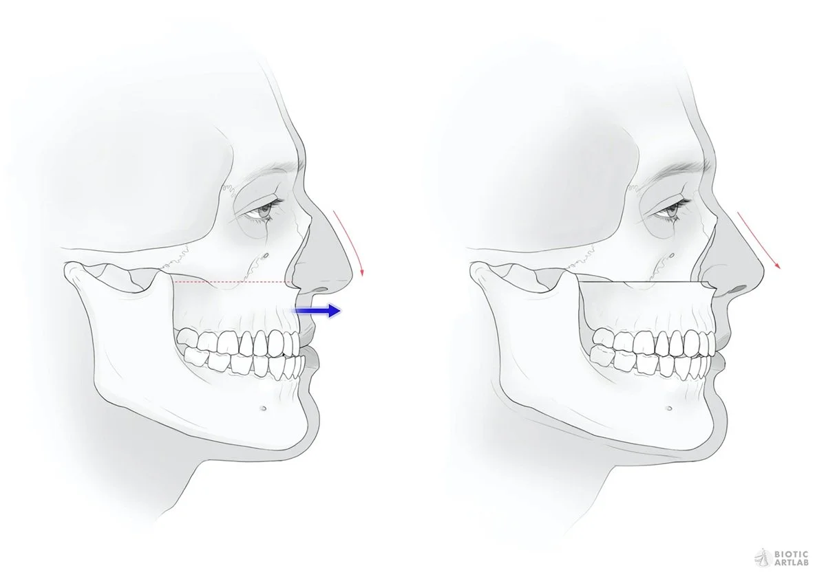 Maxillary Osteotomy | Medical Illustrations — Biotic Artlab