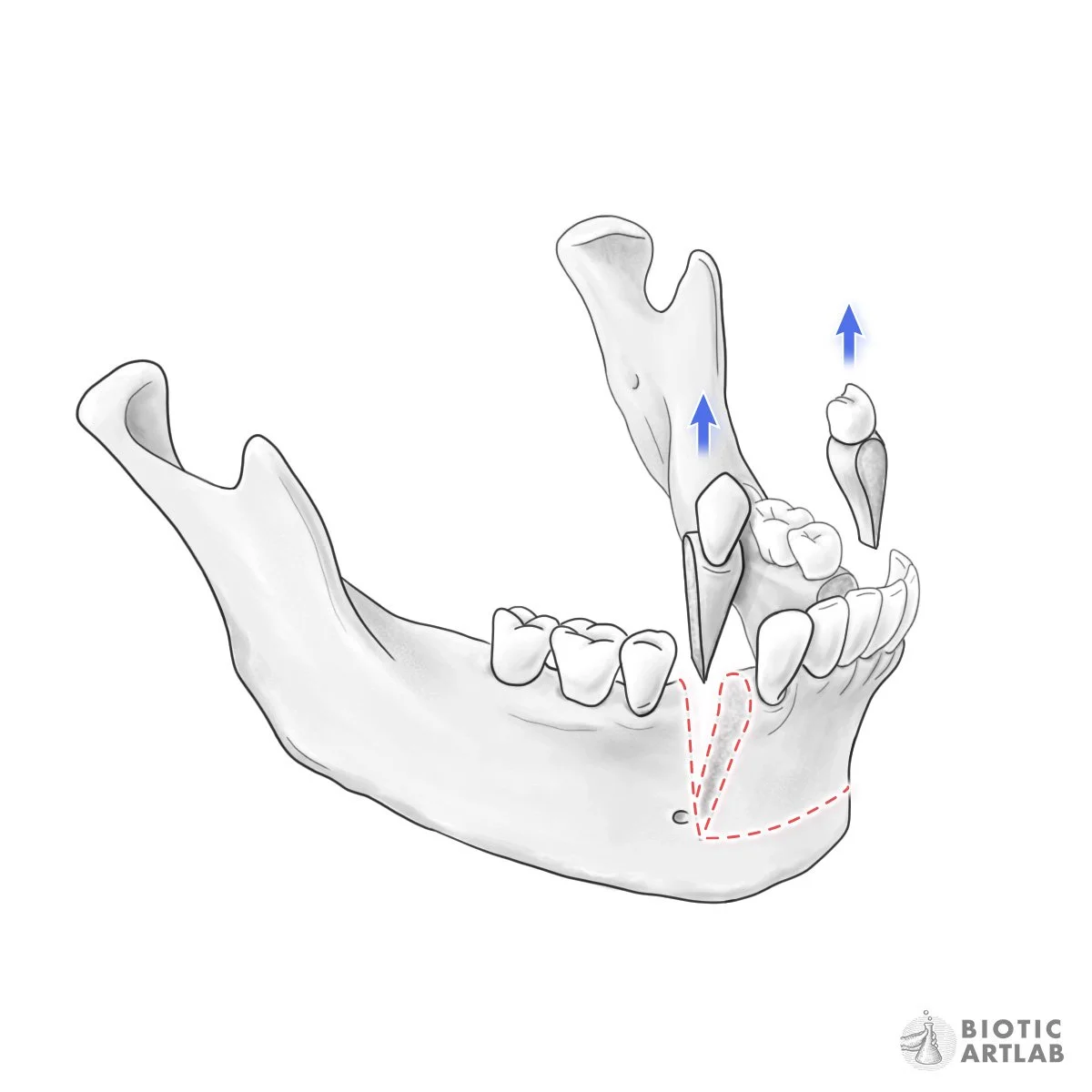 Maxillary Osteotomy | Medical Illustrations — Biotic Artlab