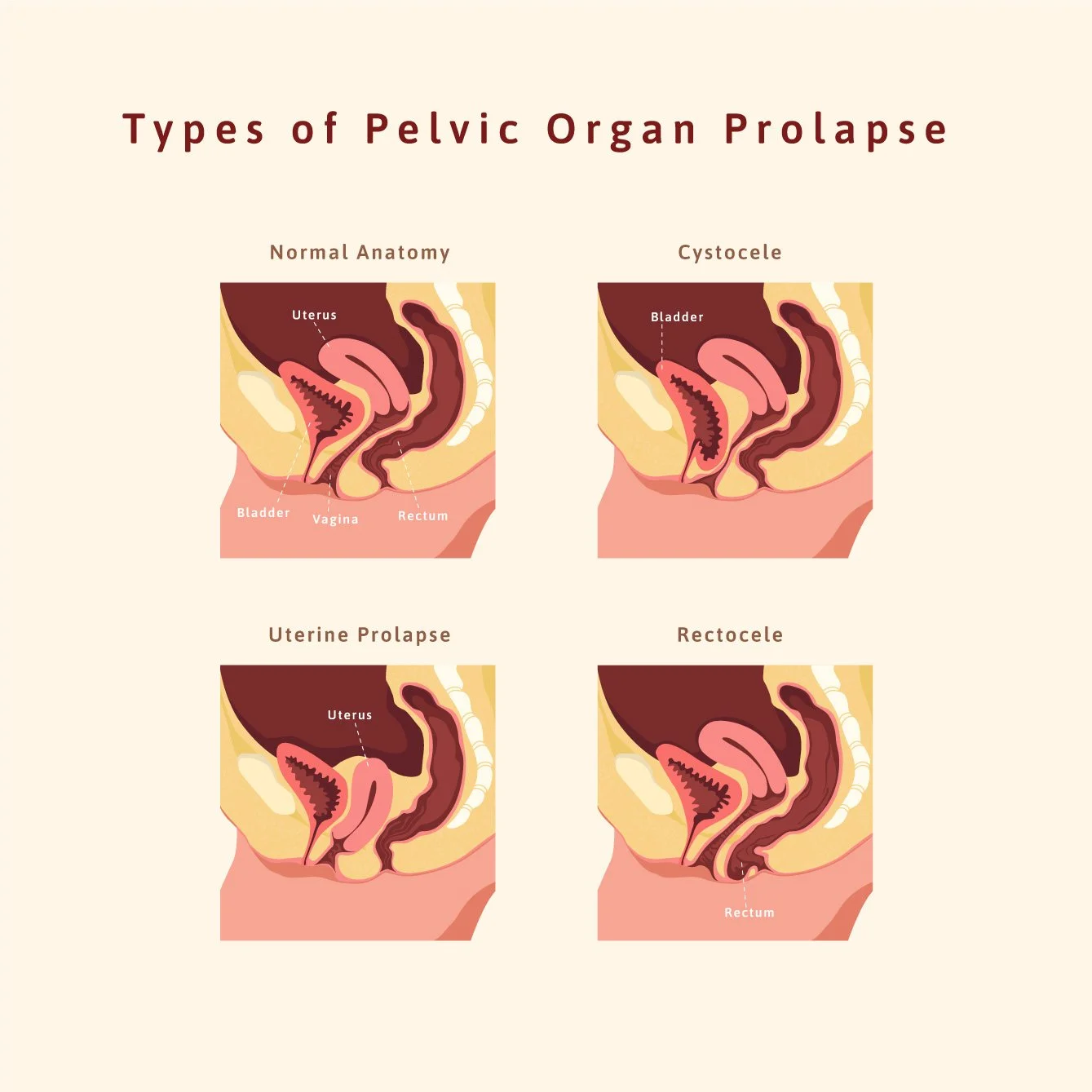 Pelvic Organ Prolapse How Physical Therapy Can Help With Symptoms And Returning To Exercise