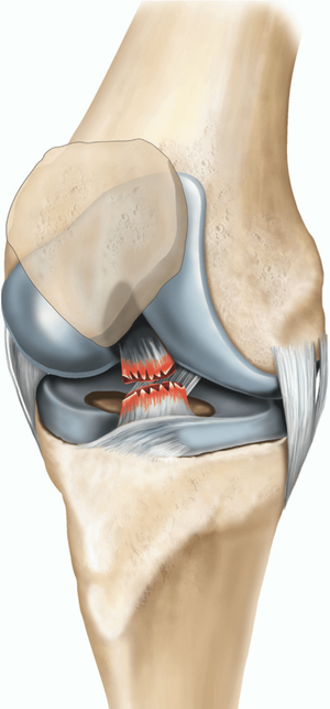 What is the Cross Bracing Protocol? Non-surgical management of ACL ...