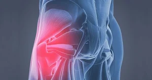 Gluteal tendinopathy — Back to Bounce Sports Physiotherapy