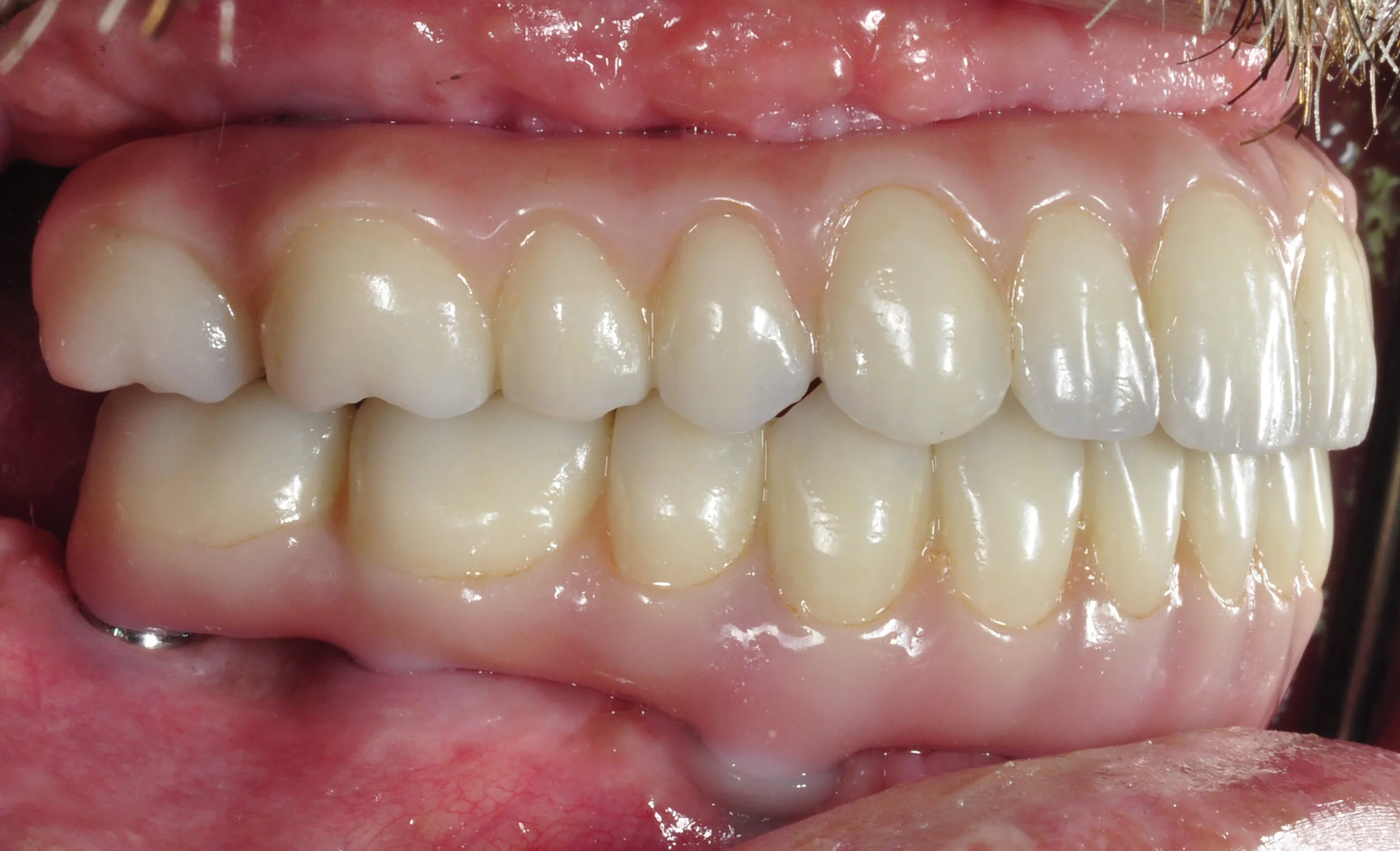 Restorations — SYNrG Lab