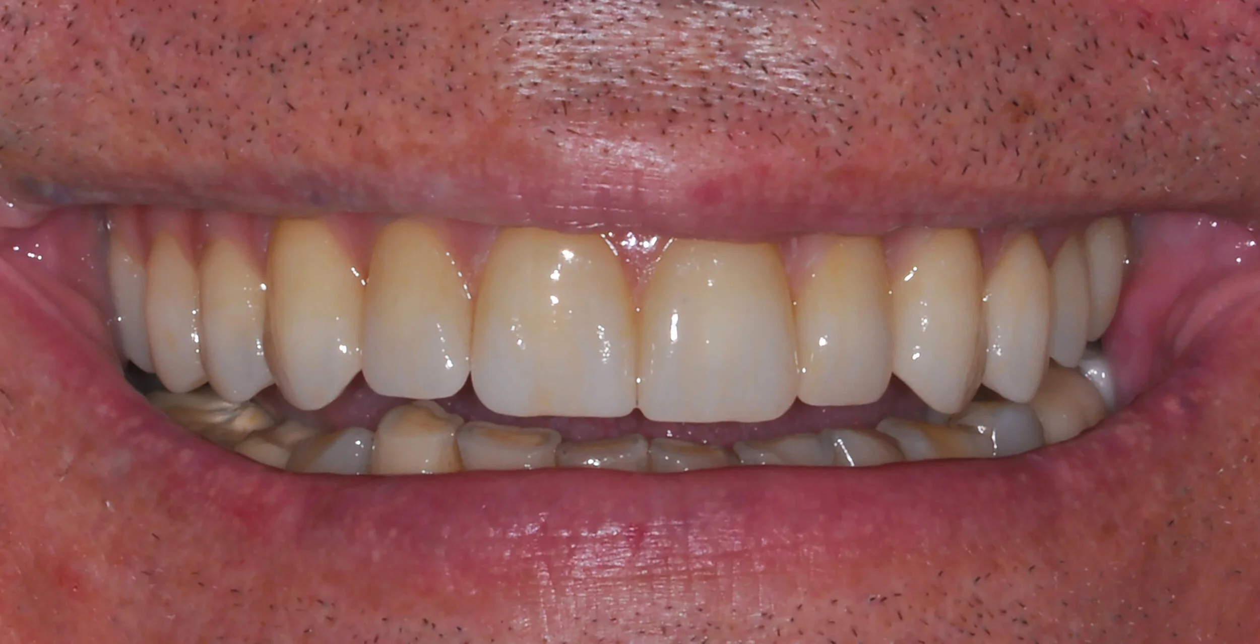 Restorations — SYNrG Lab