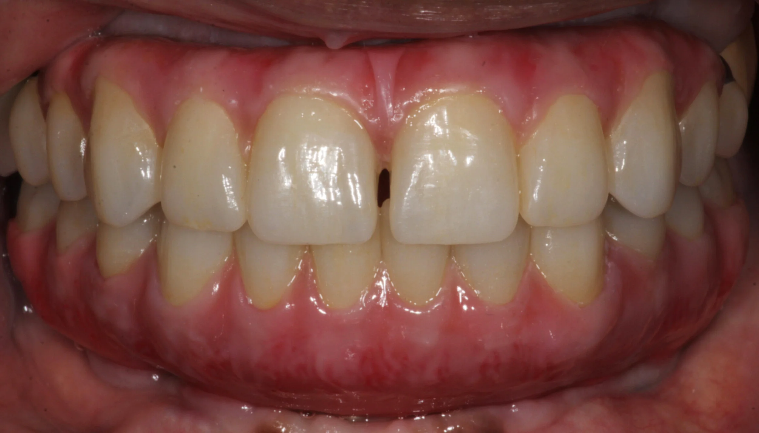 Restorations — SYNrG Lab