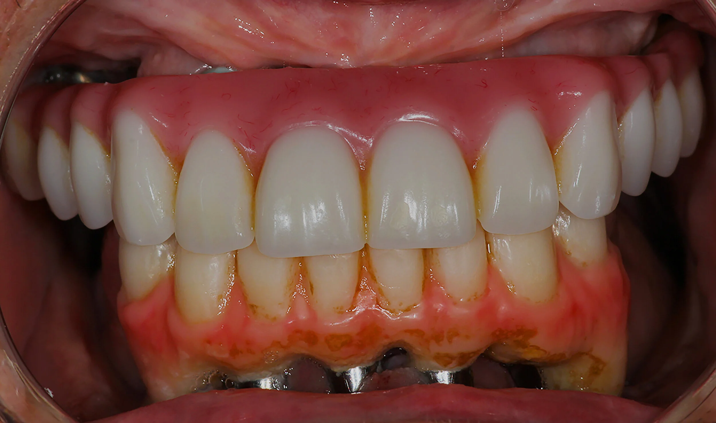 Restorations — SYNrG Lab