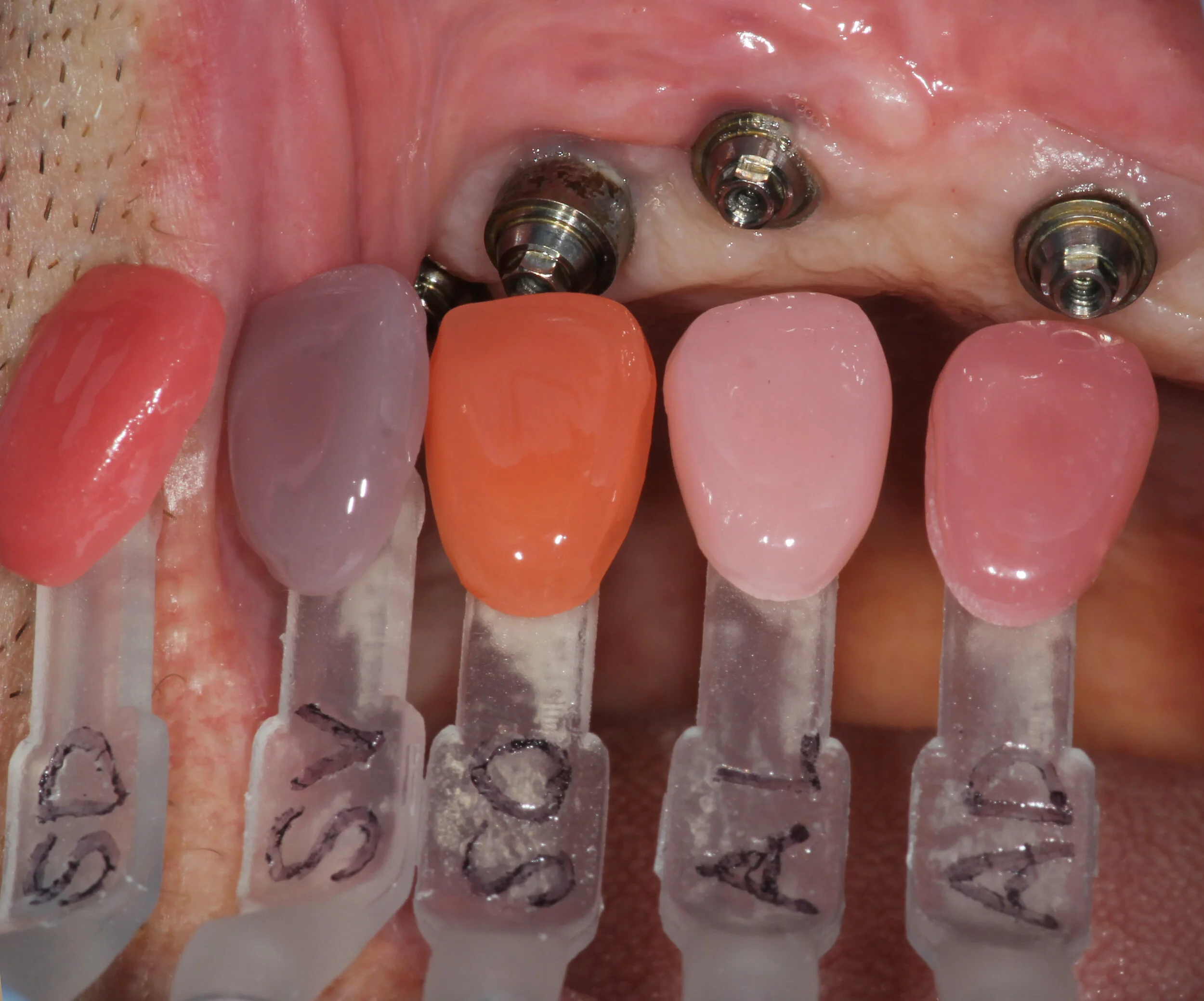 Restorations — SYNrG Lab