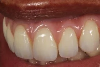 Restorations — SYNrG Lab