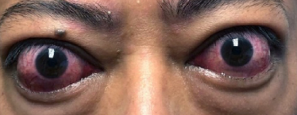 Revisiting Thyroid Eye Disease (another look at TED) — eyeThera