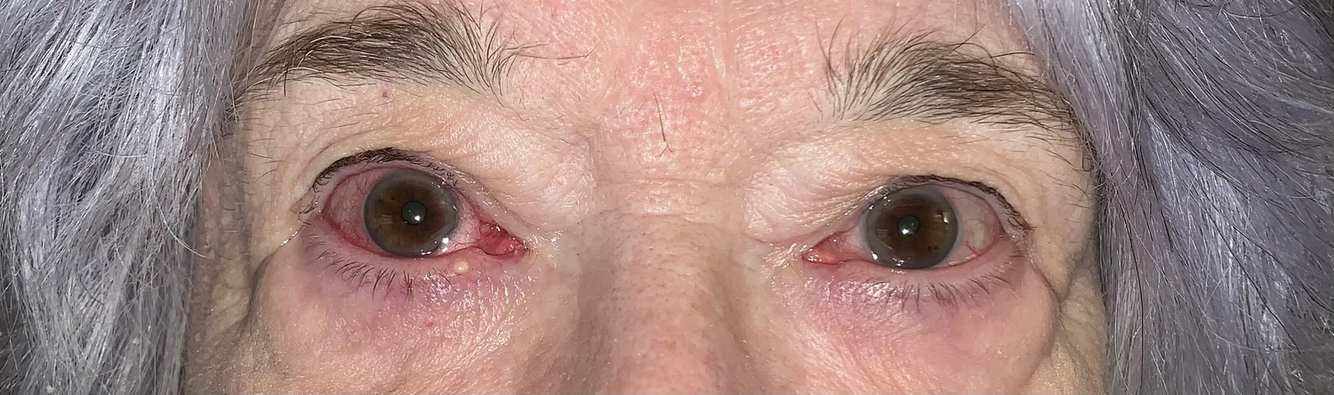What do dry eye tests mean? (Part 6) Inflammation (and how we measure ...