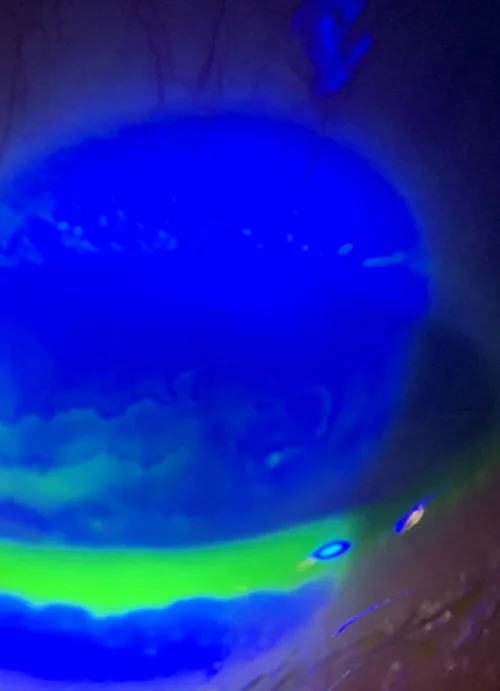 More on staining the surface of a dry eye and what it means…What do dry ...