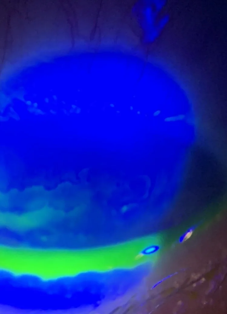 More on staining the surface of a dry eye and what it means…What do dry ...