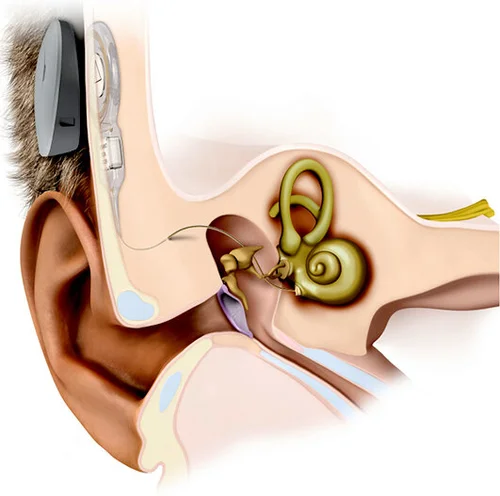 Cochlear & Implantable Hearing Devices | Bondi Junction, Sydney ...