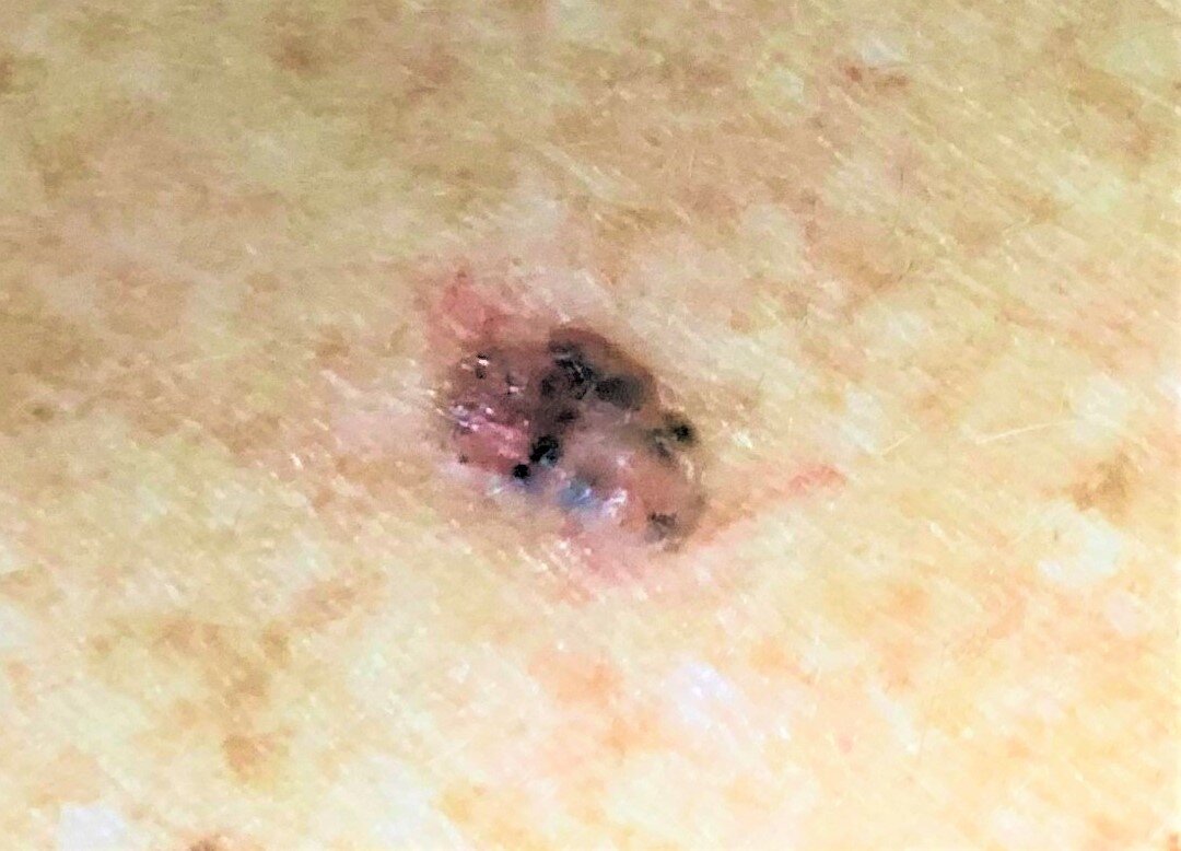 Pigmented Basal Cell Carcinoma