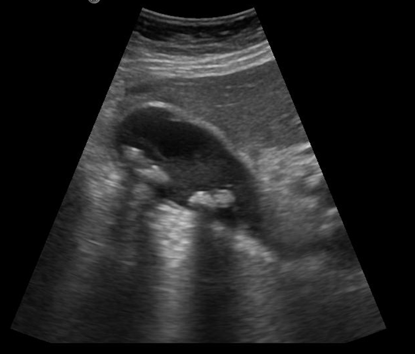 Biliary Colic Level A — St. James' Hospital Emergency Department