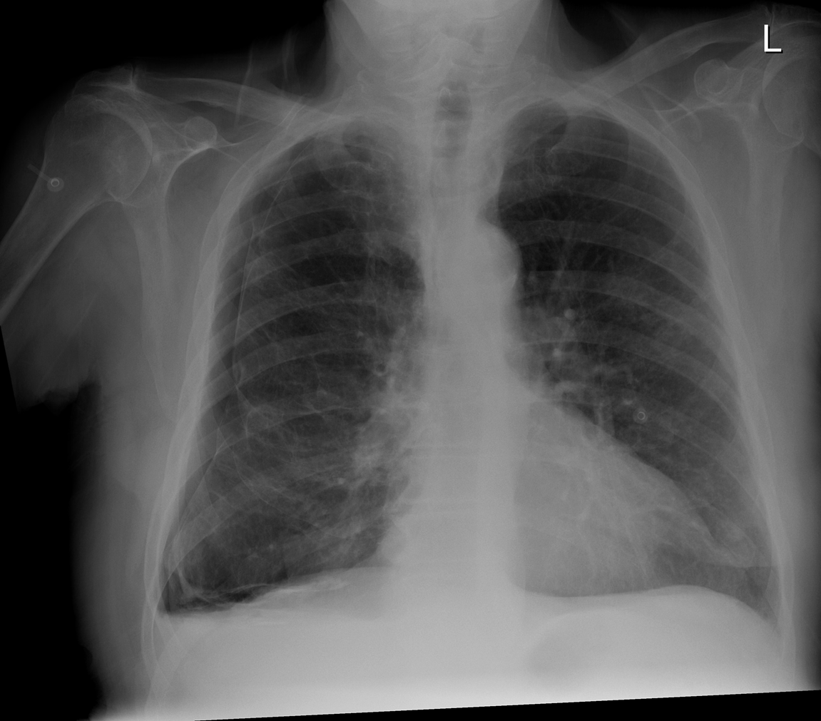 Spontaneous Pneumothorax — St. James' Hospital Emergency Department