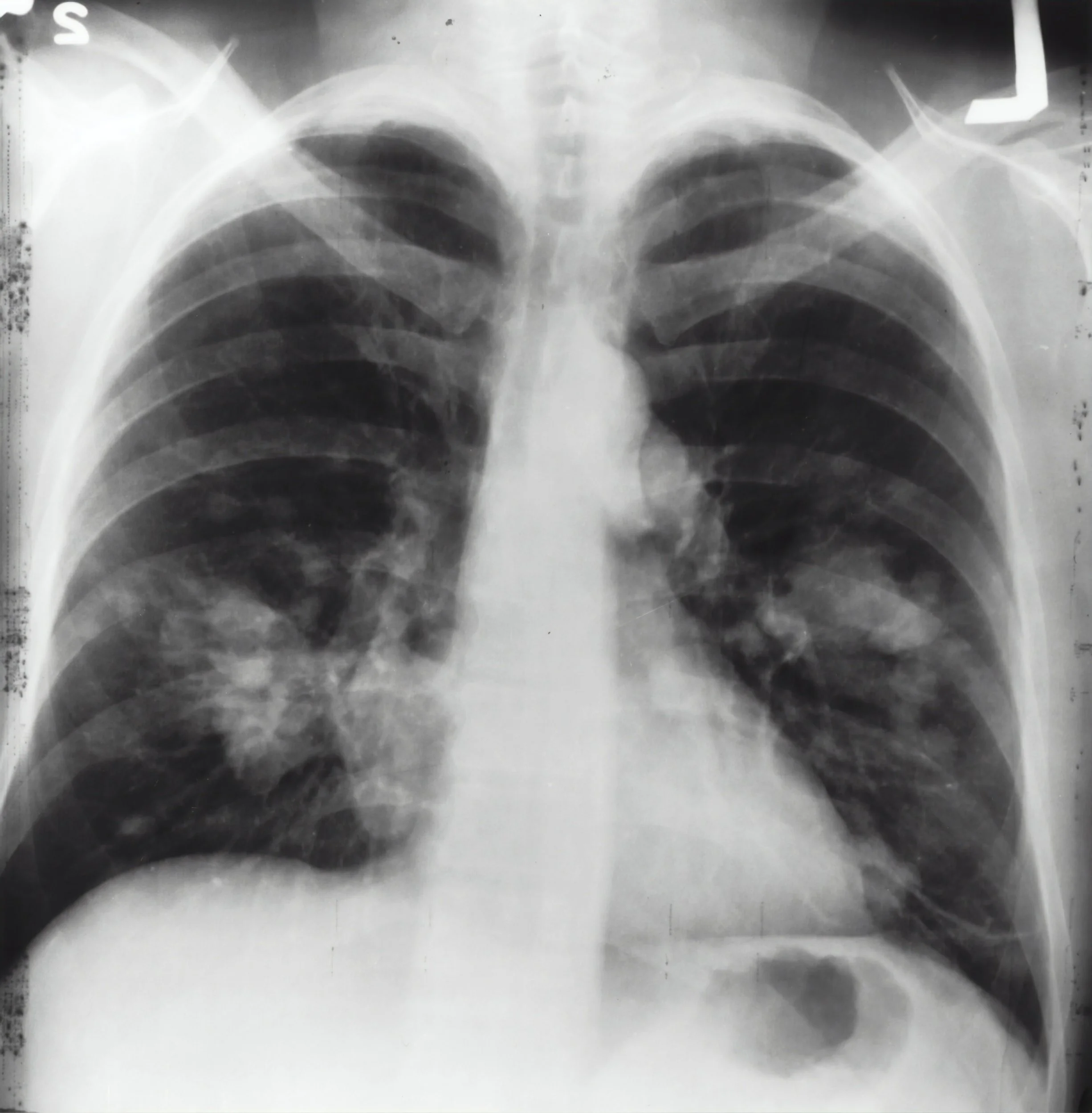 Haemoptysis Level B — St. James' Hospital Emergency Department