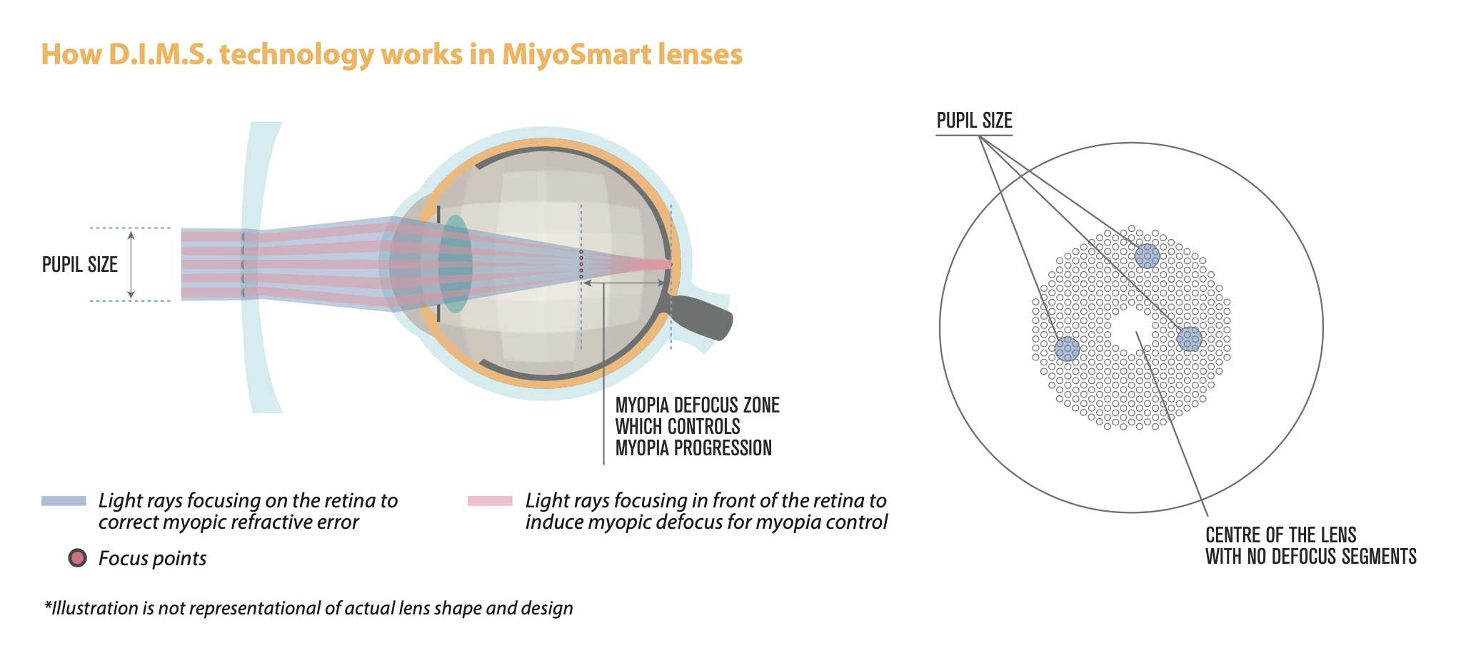 MiYOSMART Lenses and Glasses for Myopia in Vancouver