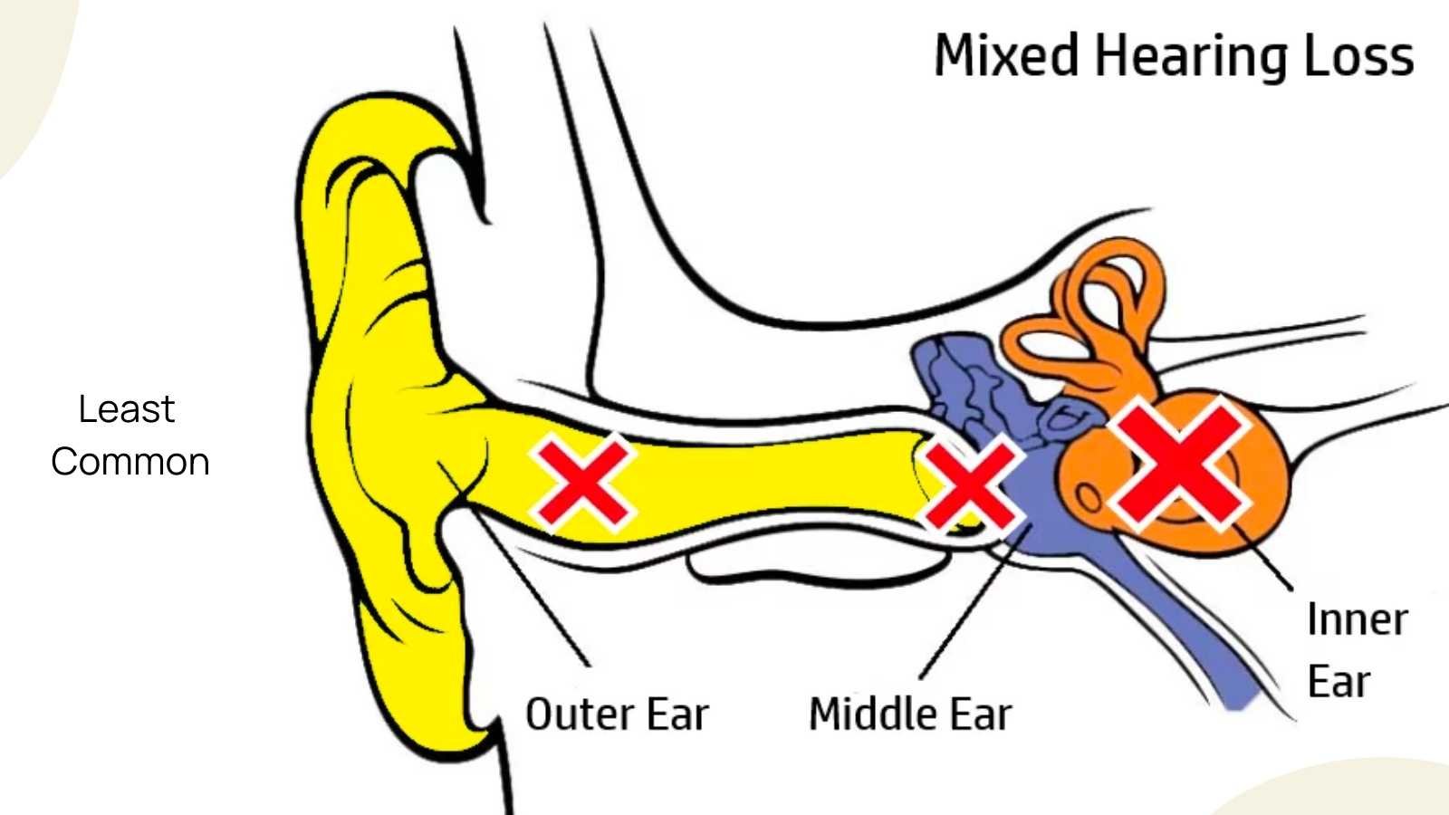Most Common Types Of Hearing Loss Sensorineural Conductive And Mixed most-common-types-of-hearing-loss-sensorineural-conductive-and-mixed