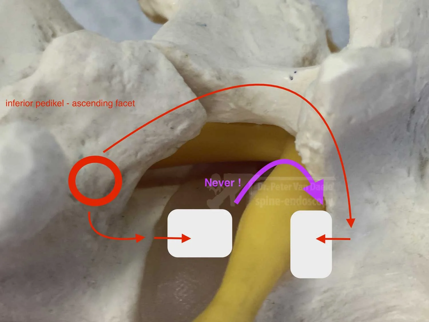 Endoscopic Approaches | Transforaminal, Interlaminar, Extra-foraminal ...