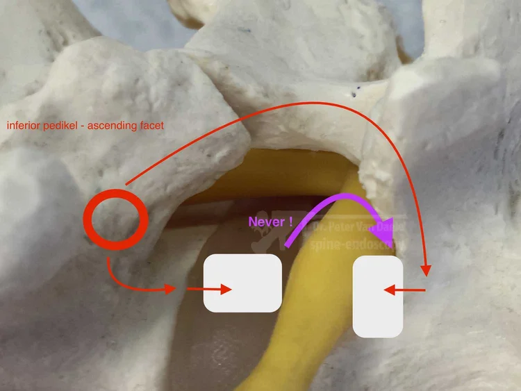 Endoscopic Approaches | Transforaminal, Interlaminar, Extra-foraminal ...