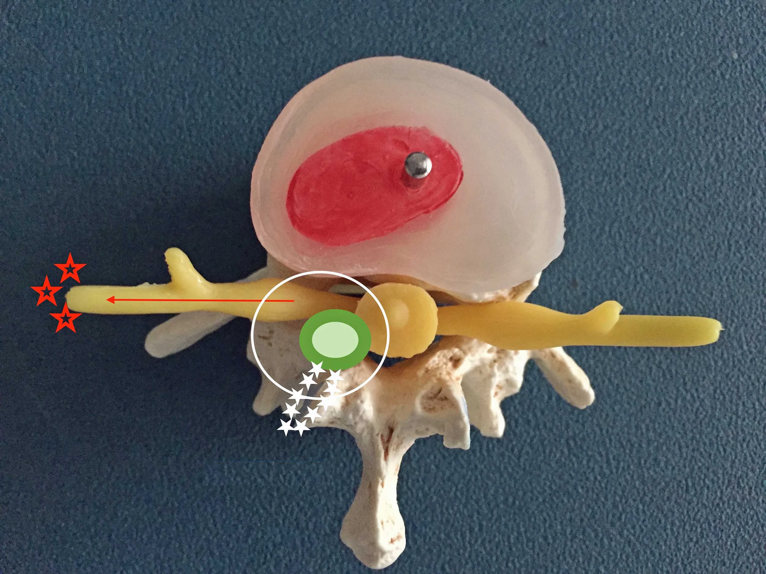 Facet Cyst In The Lumbar Spine As A Cause Of Leg Pain Spine Endoscopy