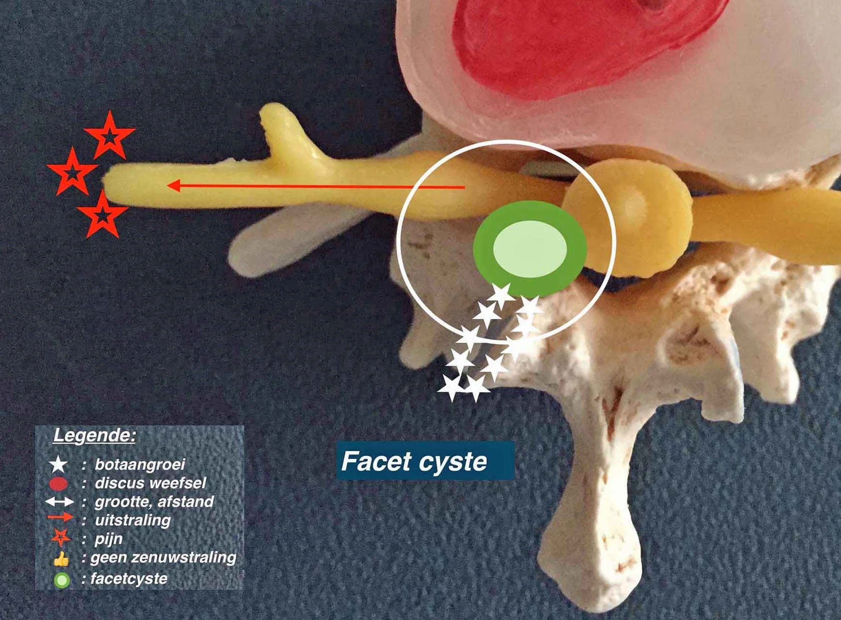 Facet Cyst In The Lumbar Spine As A Cause Of Leg Pain Spine Endoscopy