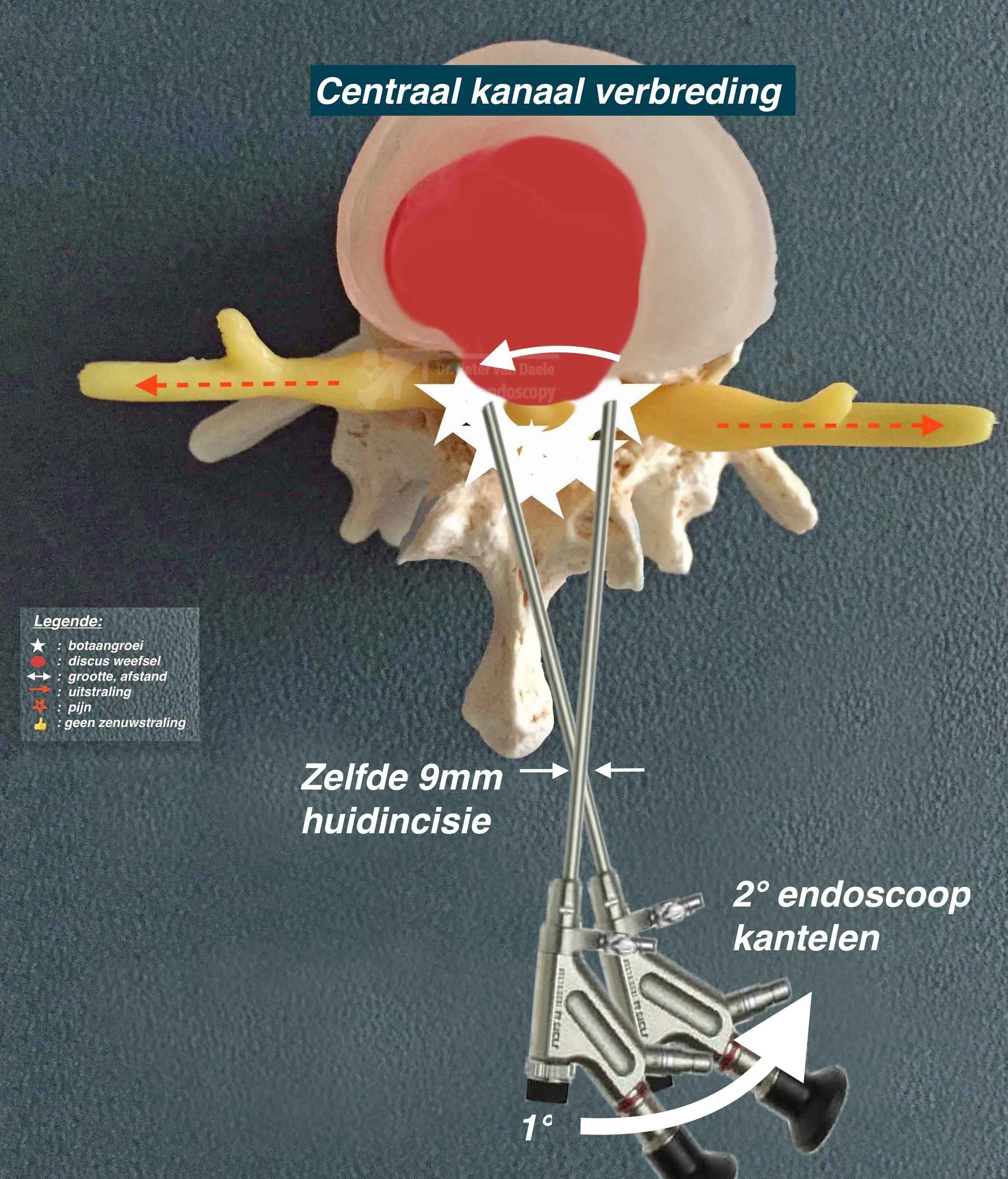 Endoscopic Canal Decompression | Lateral Recess Relief — Spine ...