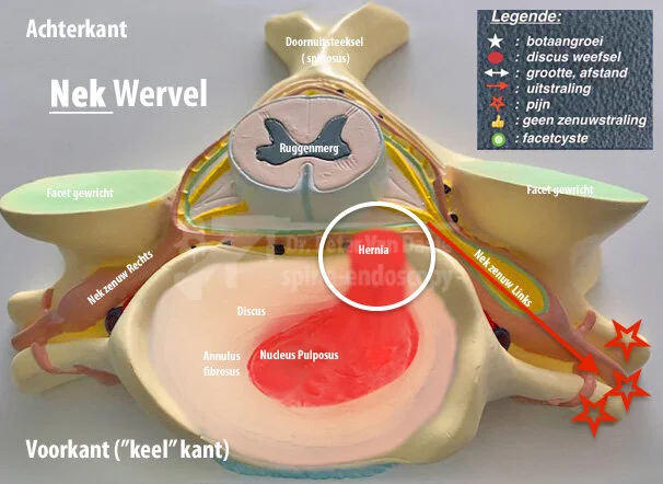 Cervical Disc Herniation | Posterior Endoscopic Care — Spine Endoscopy ...
