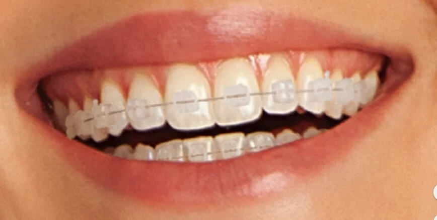 Clear Aligners & Metal Braces In Williamsport, PA | Hayes & Hayes, LLC