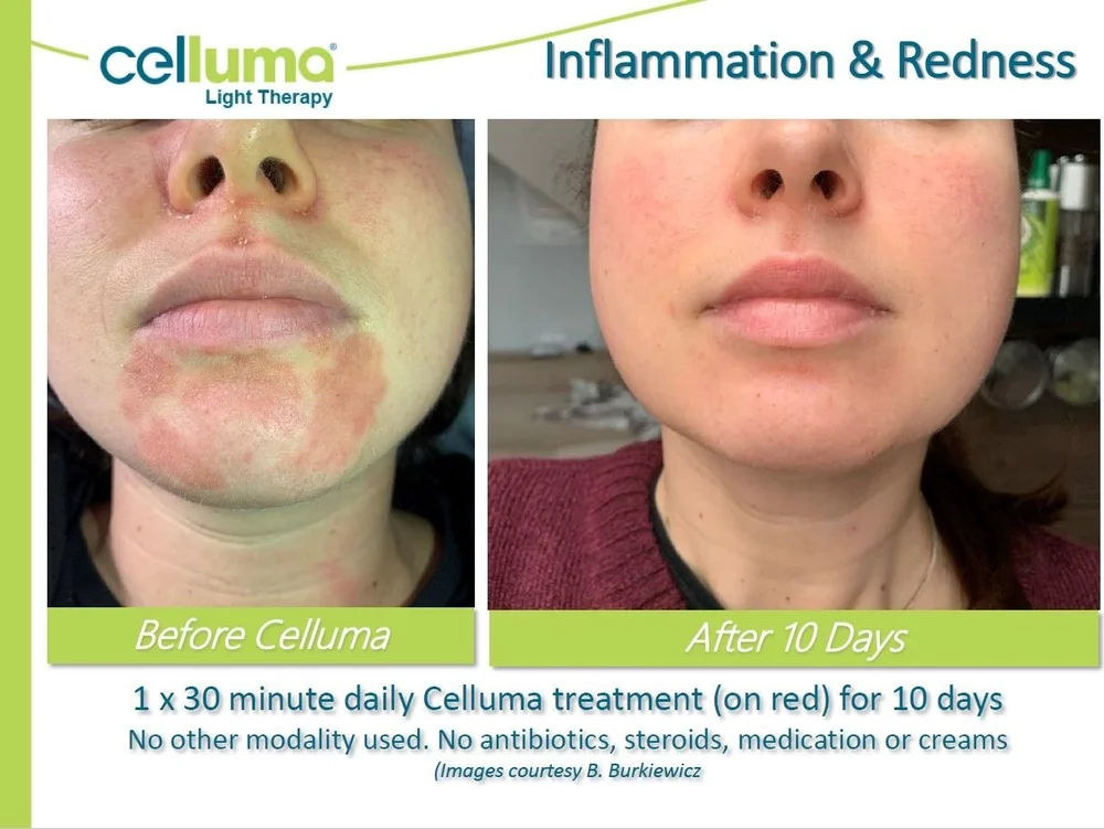 Transform Your Skin with Celluma LED Light Therapy | Treatment Benefits ...