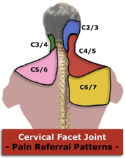 Whiplash Injury: Causes, Symptoms, and Effective Treatment Options ...