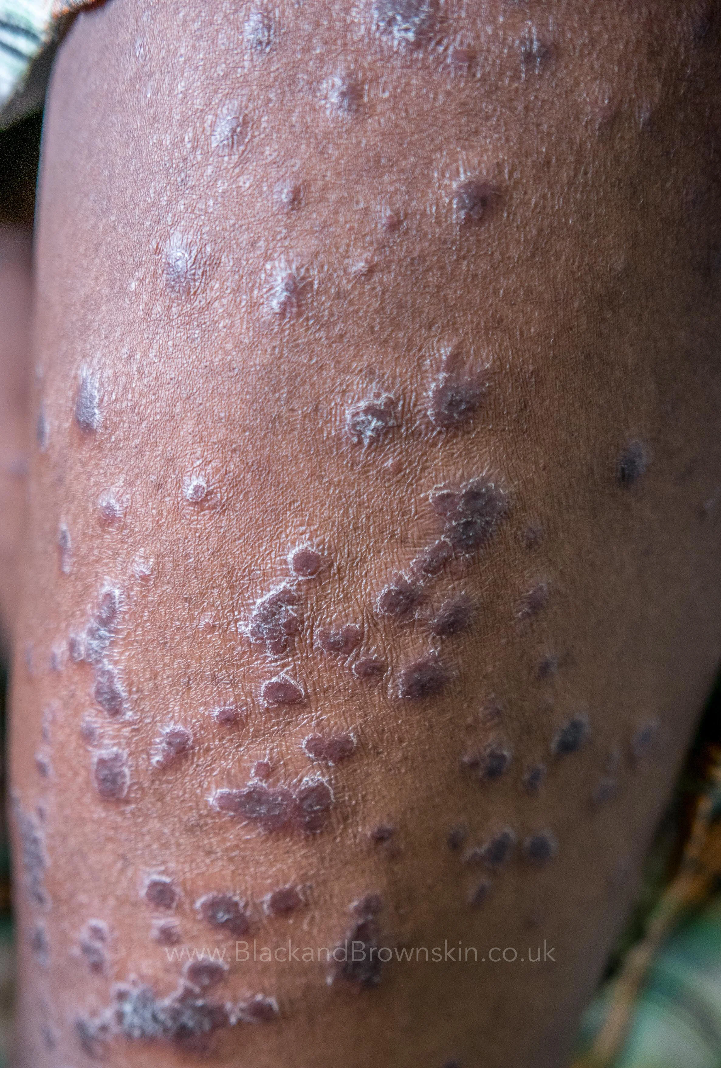 Lower Limb — Black & brown skin