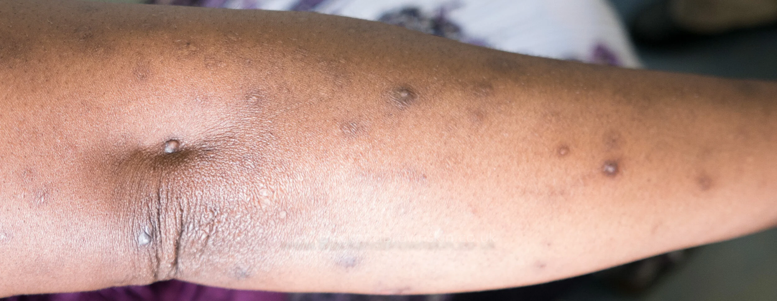 Upper Limb — Black & brown skin