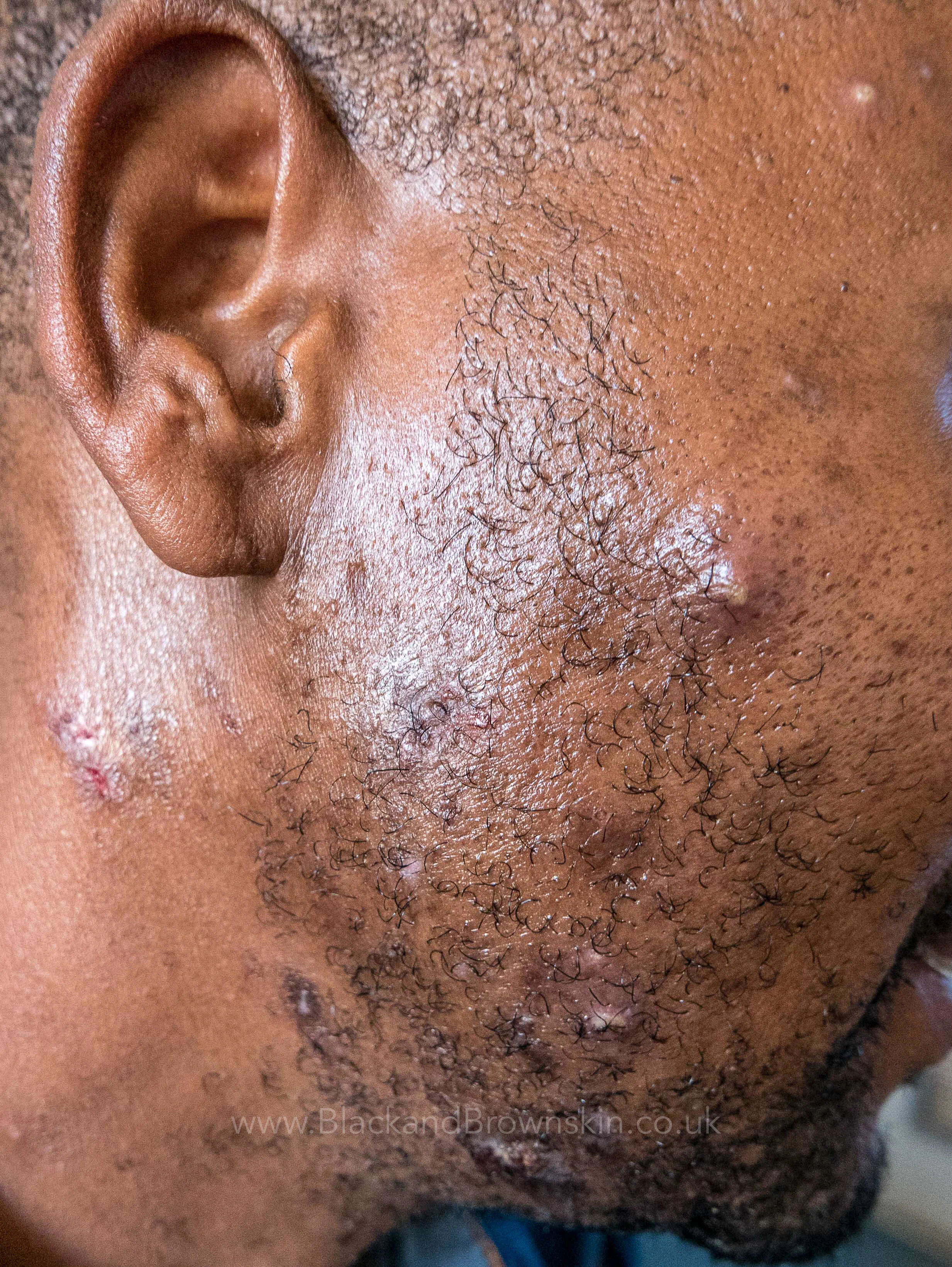 Head and Neck — Black & brown skin