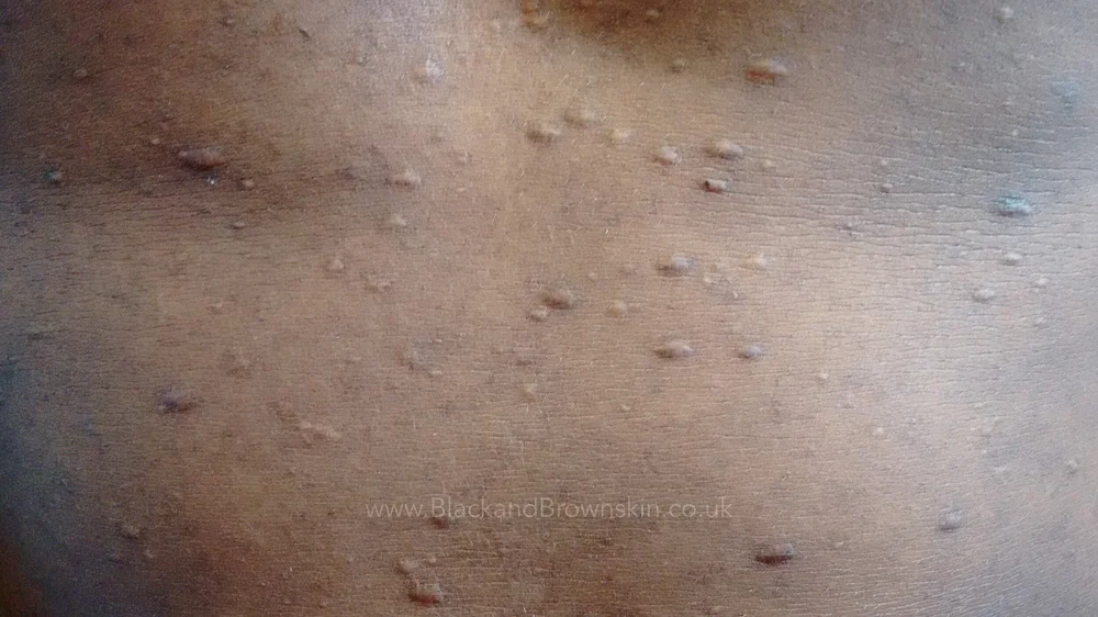 Chicken Pox On African American Skin