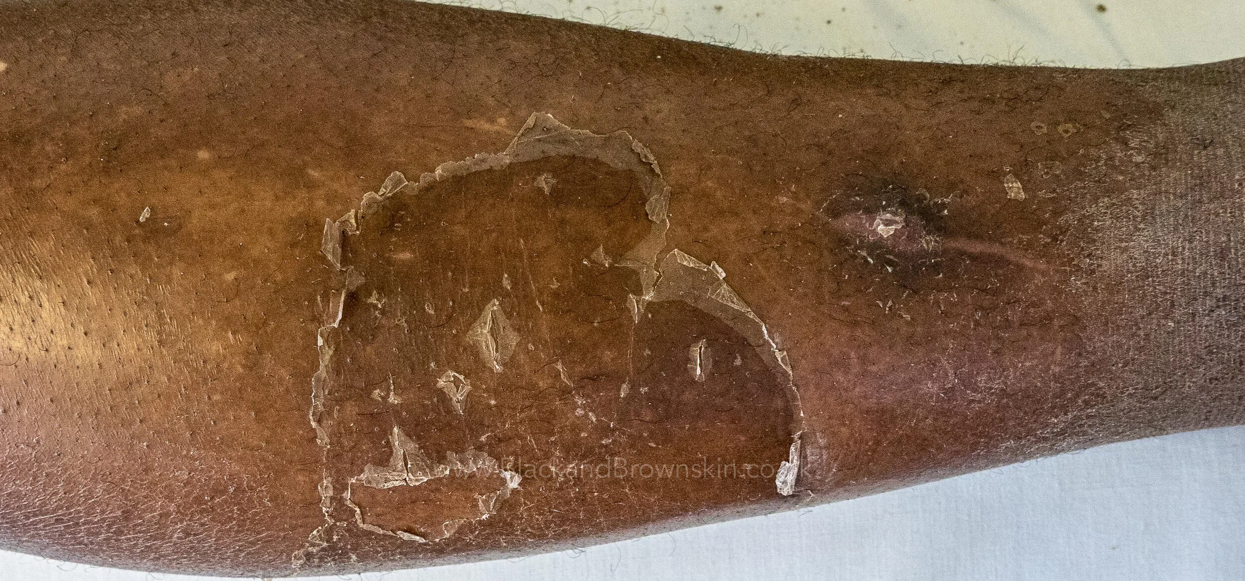 Lower Limb — Black & brown skin