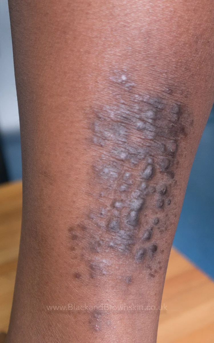 Upper Limb — Black & brown skin