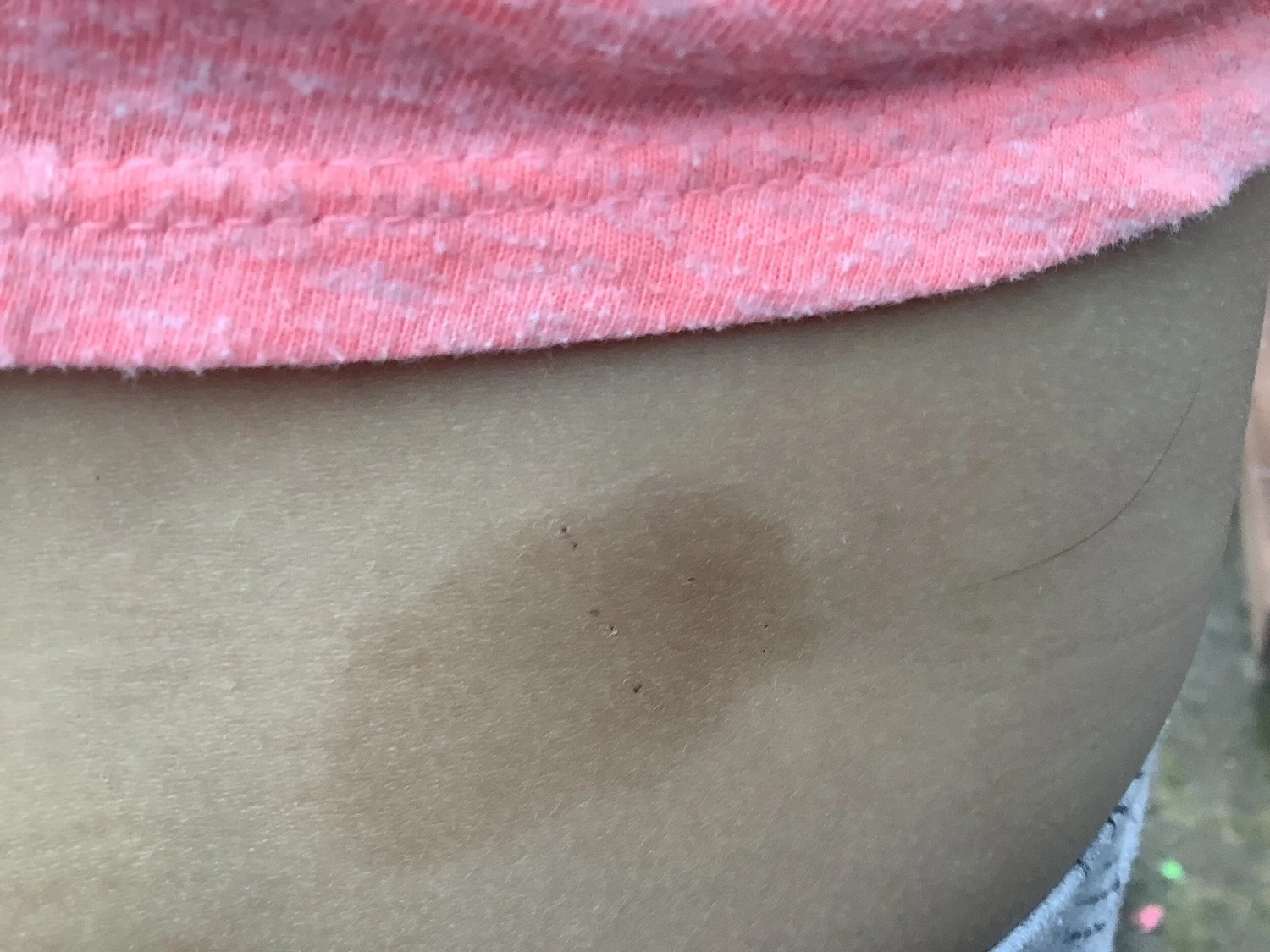 Neurofibromatosis Type 1 Cafe Au Lait Spots