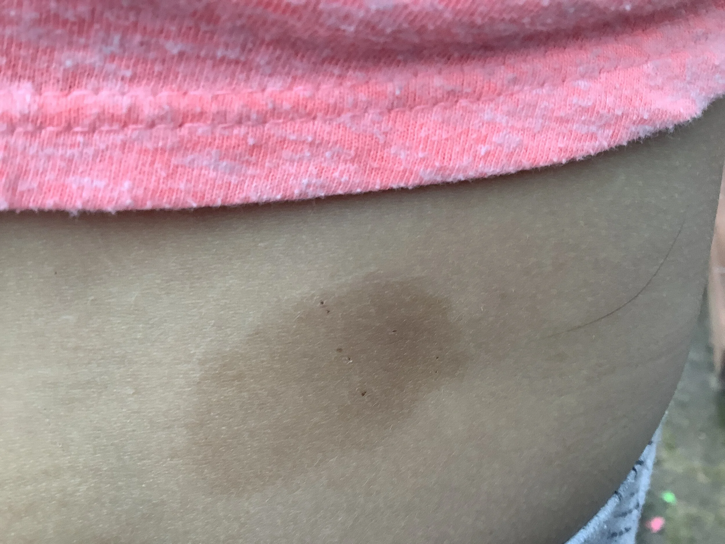 Abdomen — Black & brown skin