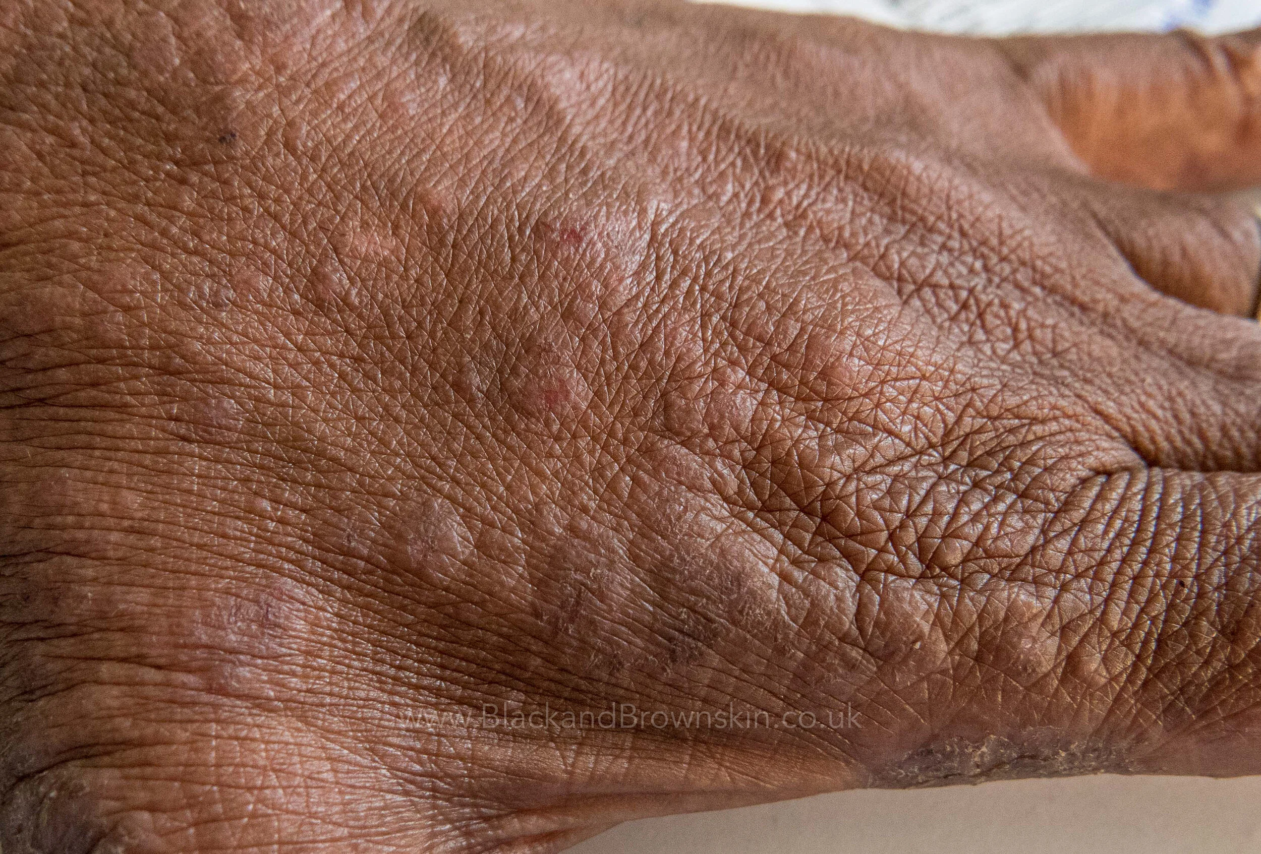 Upper Limb — Black & brown skin