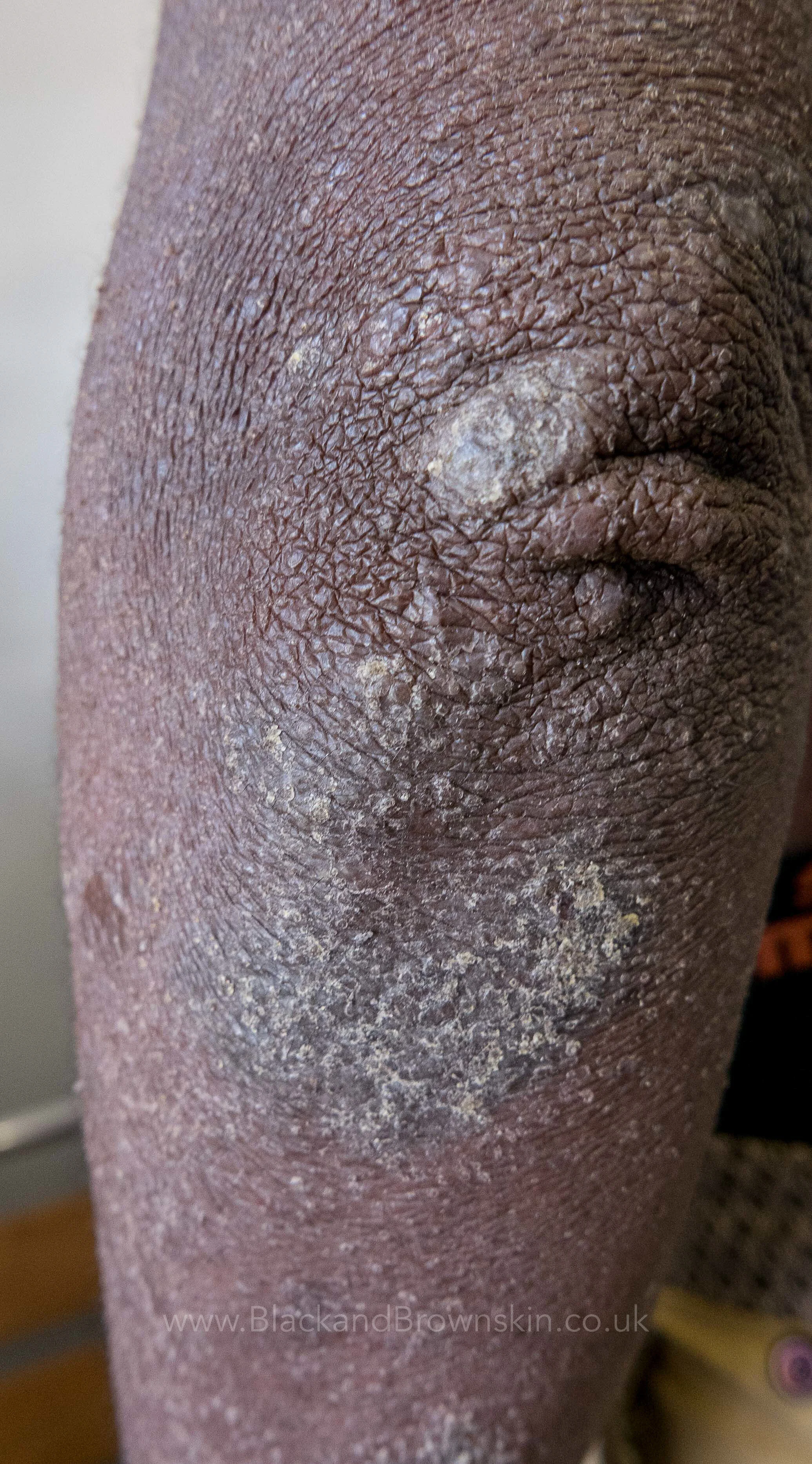 Upper Limb — Black & brown skin