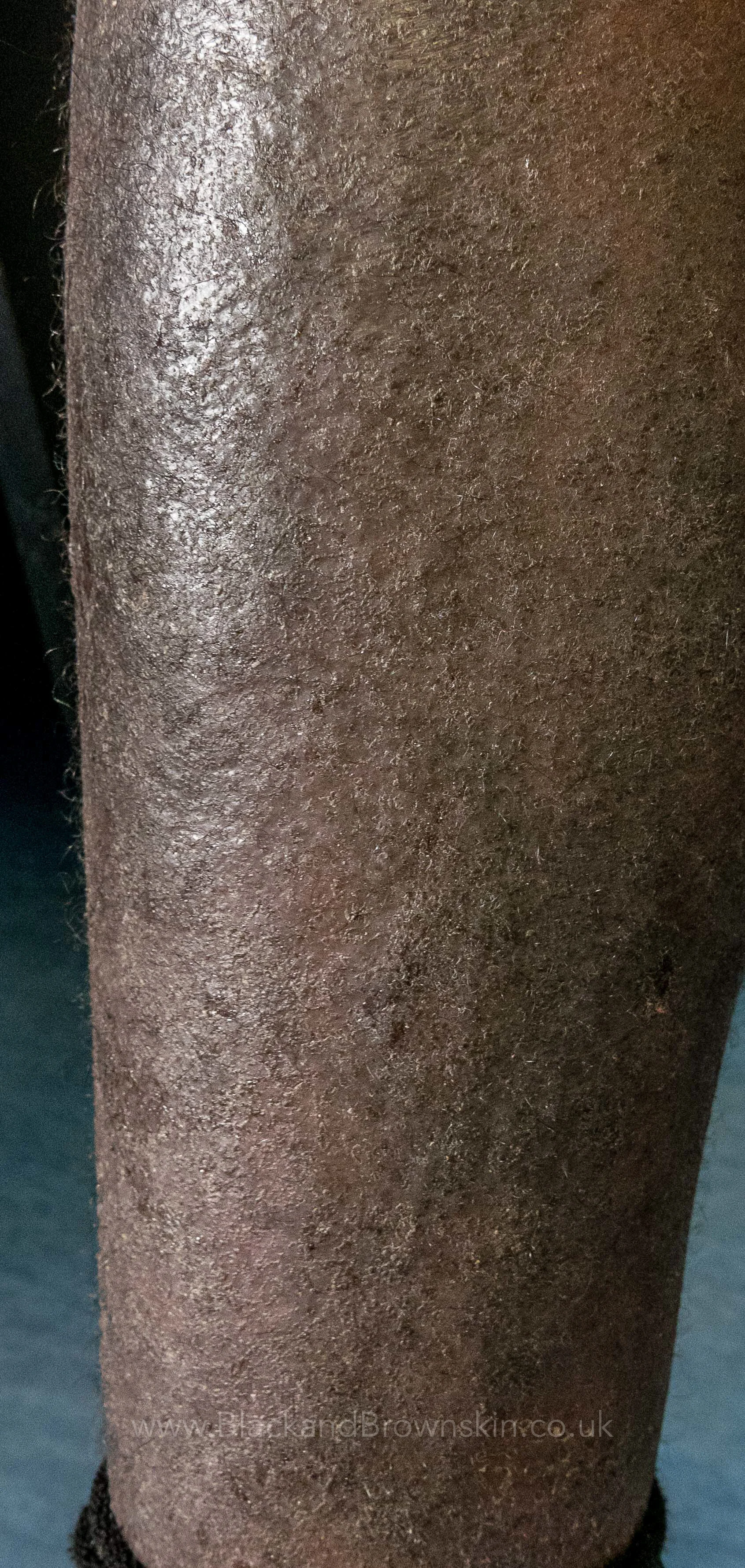 Lower Limb — Black & brown skin