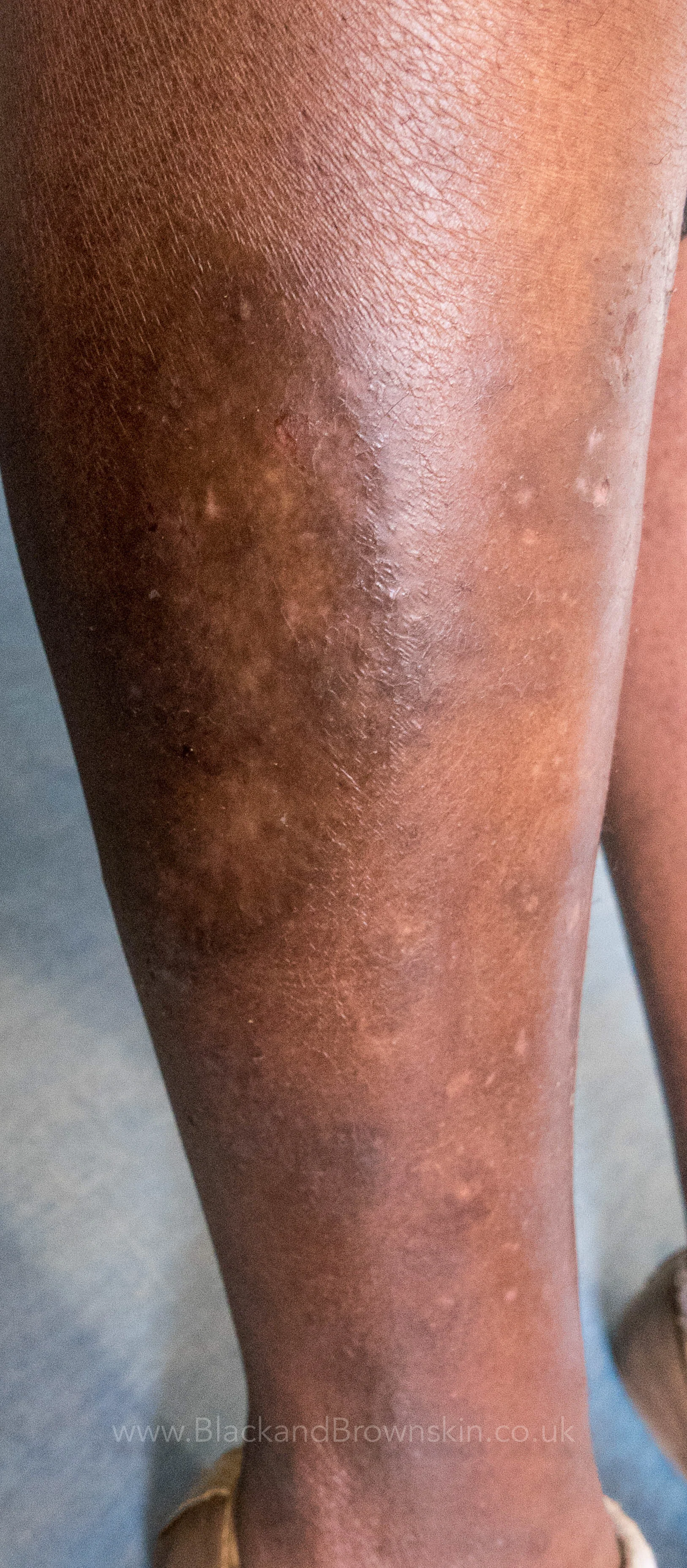 Lower Limb — Black & brown skin